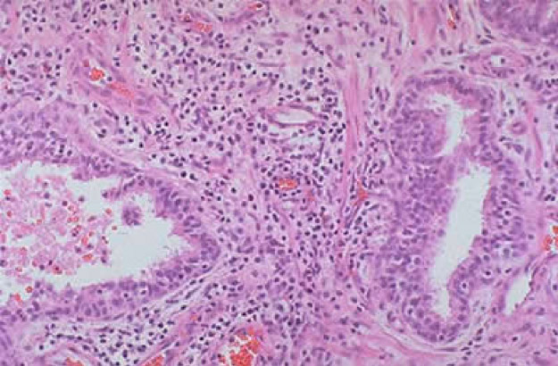 La Prostatite - Studio Urologico Gallo | Studio Urologico Gallo